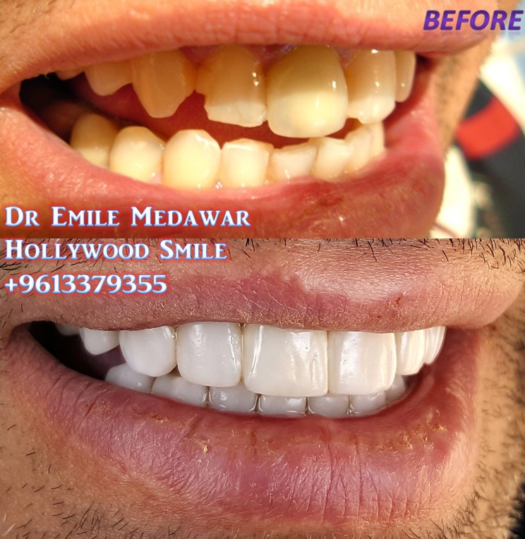 Emax Veneers