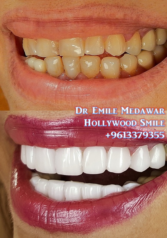 Emax Veneers